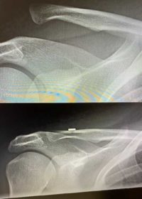 AC | Acromioclavicular Joint Repair | Orthopedic Shoulder Doctor ...