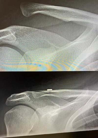 AC Joint Injury | Separated Shoulder | Orthopedic Specialist ...