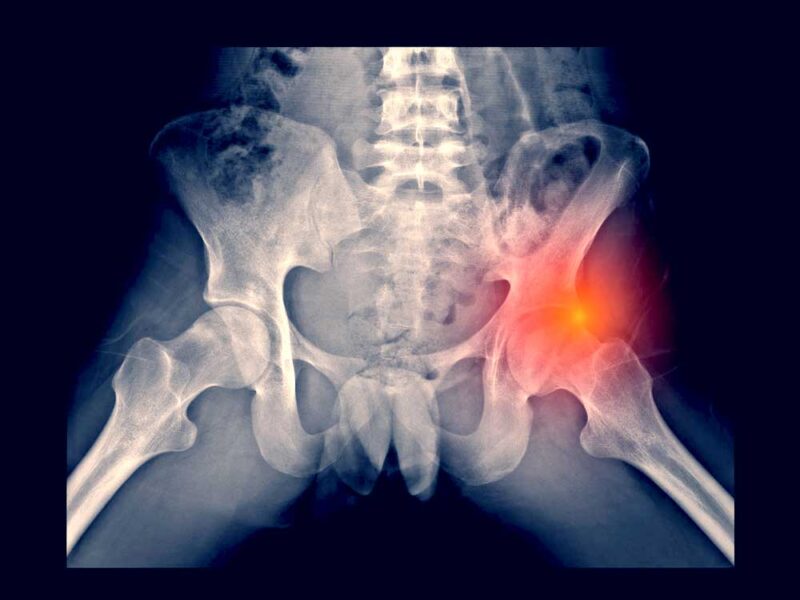 Femoroacetabular Impingement (FAI) & Hip Pain Orthopedic Specialist ...