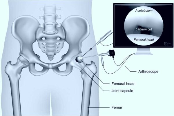 Hip Arthroscopy | Hip Scope Surgeon | Manhattan, New York, NY