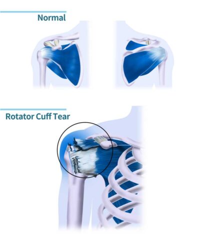 Rotator Cuff Injury | Orthopedic Shoulder Specialist | Manhattan, New ...