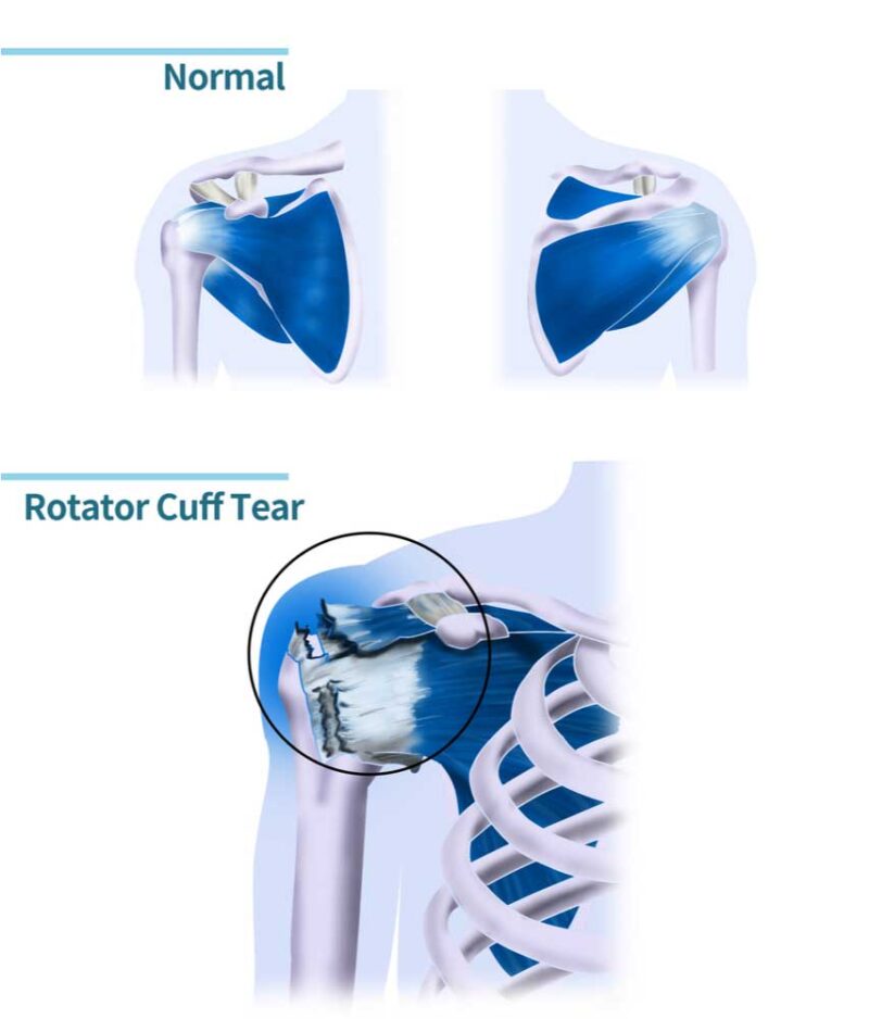 Rotator Cuff Injury | Orthopedic Shoulder Specialist | Manhattan, New ...