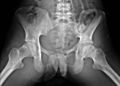 Femoroacetabular Impingement (FAI) | Hip Impingement Specialist | Hip ...