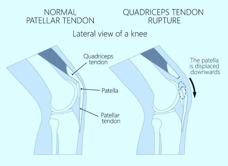 Knee Treatments Archives - Benedict Nwachukwu, MD, MBA | Hip, Knee ...