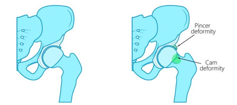 Cam Deformity Femoral Head | Cam Lesion | Hip Impingement (FAI ...