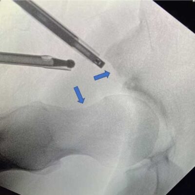 Subspine Decompression | Hip Impingement | Orthopedic Hip Surgeon ...