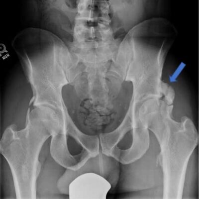 Excision of Heterotopic Ossification | Hip Impingement | Orthopedic Hip ...