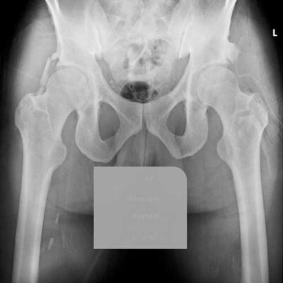 Excision of Heterotopic Ossification | Hip Impingement | Orthopedic Hip ...