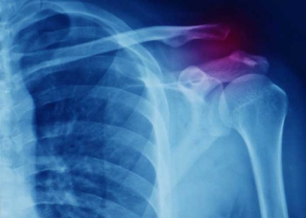 AC | Acromioclavicular Joint Repair | Orthopedic Shoulder Doctor ...